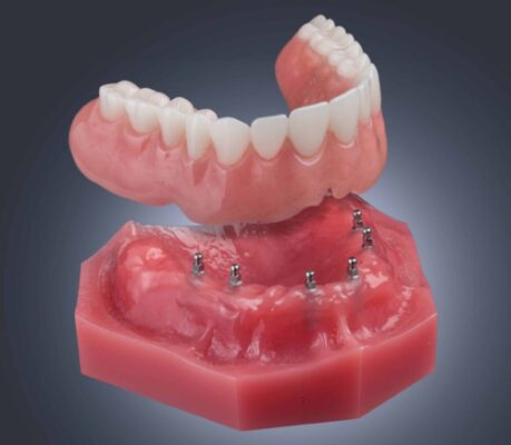 ¿Cuáles son los beneficios de los mini implantes dentales?